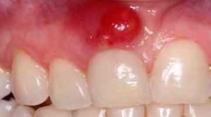 Que saber sobre los abscesos en la boca – White Smile Estetica Dental ...